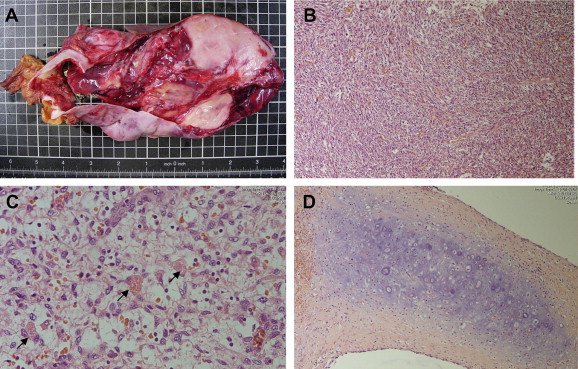 Undifferentiated embryonal sarcoma of the liver with focal osteoid ...
