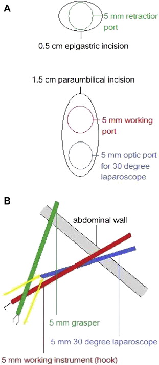 From multi-incision to single-incision laparoscopic cholecystectomy ...