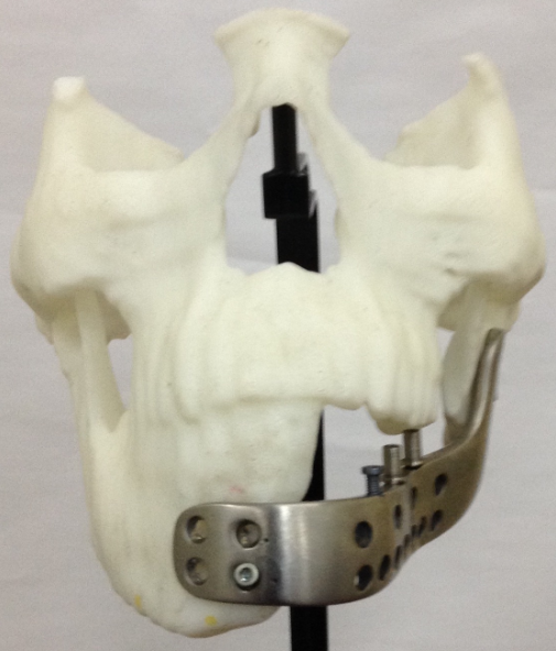 Design and manufacture of a customised temporomandibular prosthesis ...